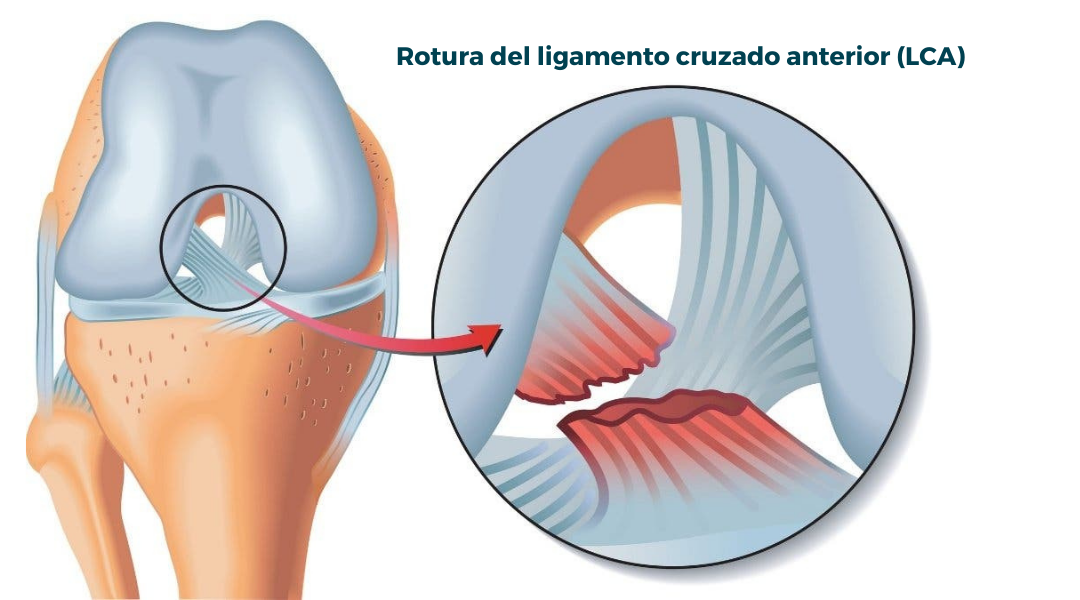 Plastia de ligamento cruzado anterior y posterior - Procedimientos ...
